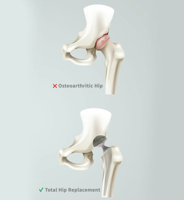 Patient Information – Hip – Signature Orthopaedics