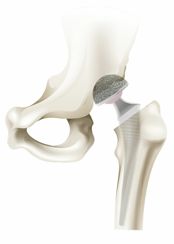 Patient Information – Hip – Signature Orthopaedics