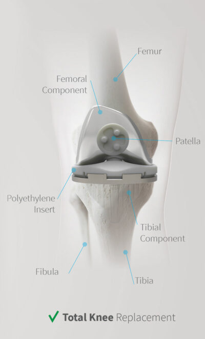 Patient Information – Knee – Signature Orthopaedics