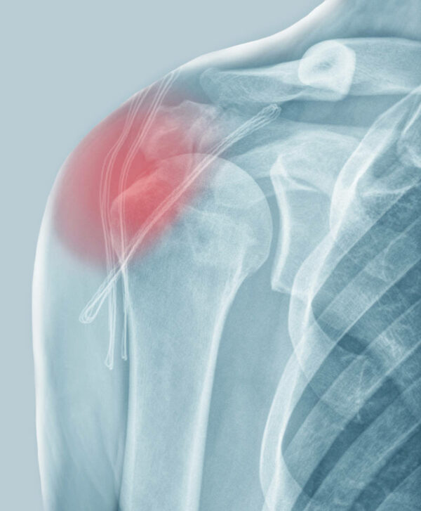 Patient Information – Soft Tissue – Signature Orthopaedics